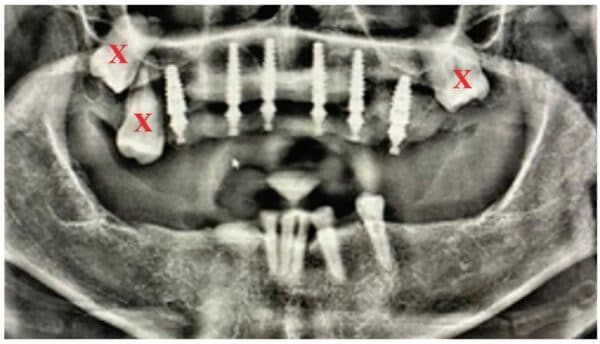 Photogrammetry — advancement in digital technology for implants