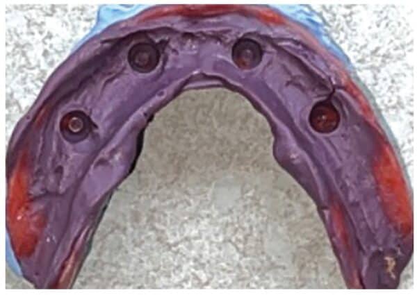 Photogrammetry — advancement in digital technology for implants