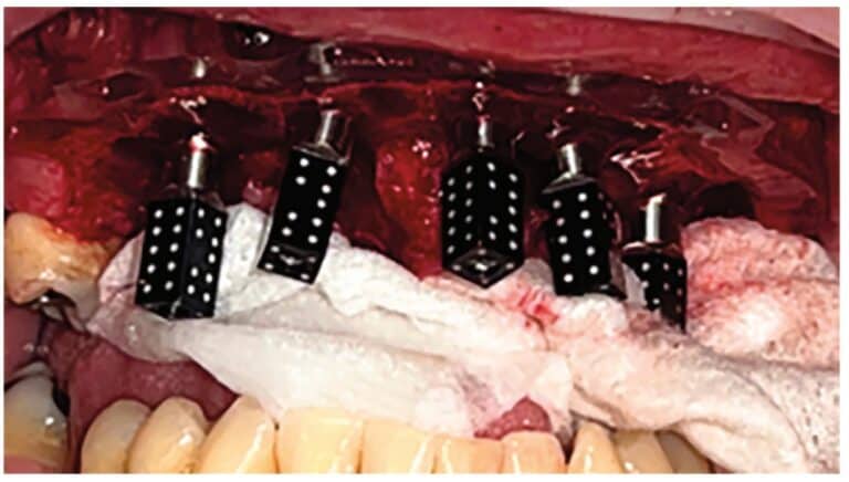 Photogrammetry — advancement in digital technology for implants