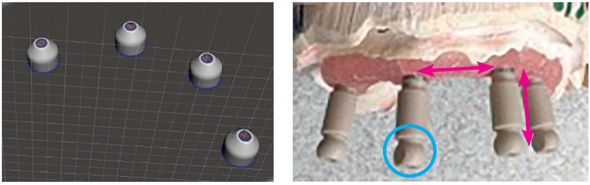 Photogrammetry — advancement in digital technology for implants