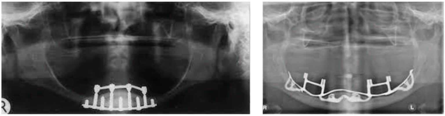 Multiple restorative challenges — see results of trans-canine implant ...