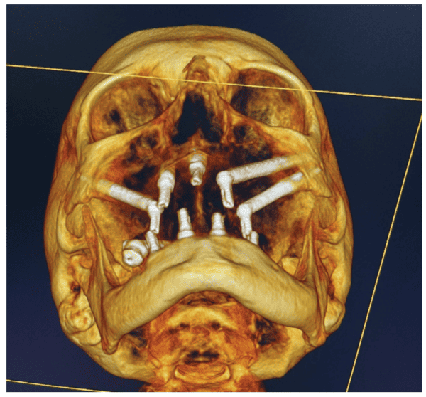 PATZI protocol — for severely atrophic maxillae
