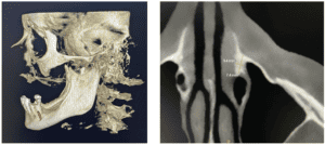 PATZI protocol — for severely atrophic maxillae