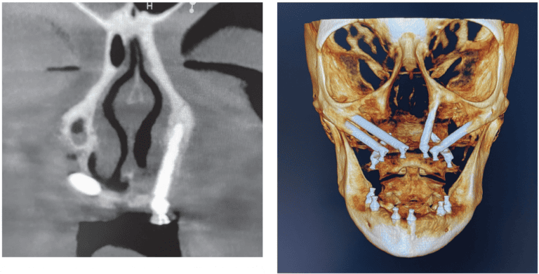PATZI protocol — for severely atrophic maxillae
