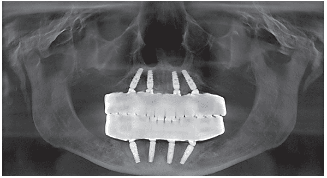 All-On-X implants — considerations over time