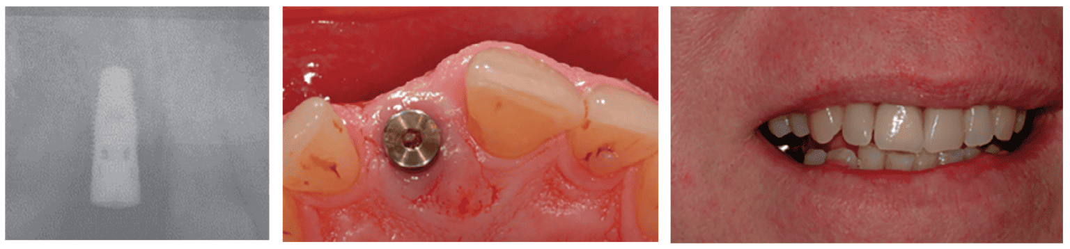 Preat — providing solutions for restorative consistency