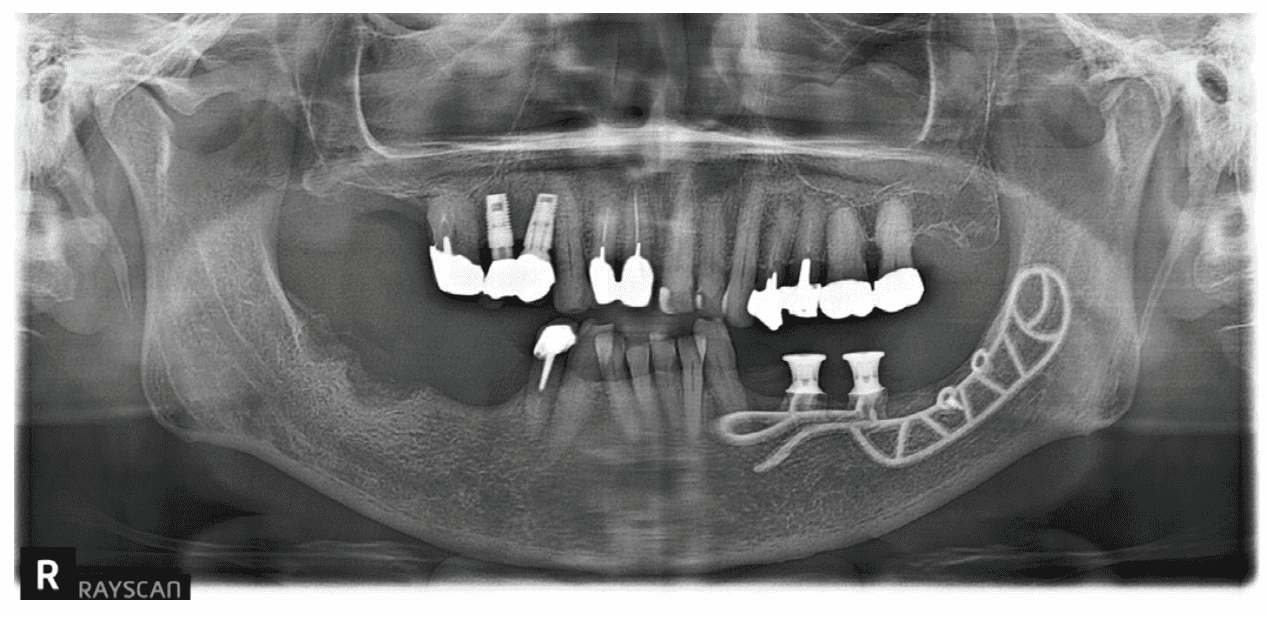 The CAD/CAM SUB Implant™ by Panthera Dental — managing atrophic ...