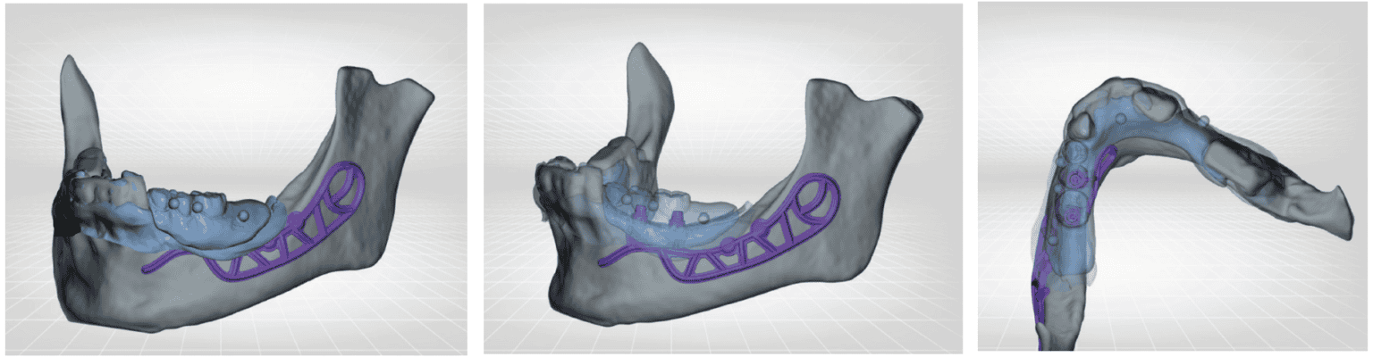 The CAD/CAM SUB Implant™ by Panthera Dental — managing atrophic ...