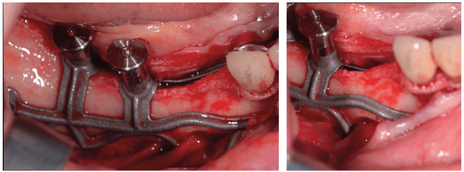 Subperiosteal implants — customization with CAD/CAM