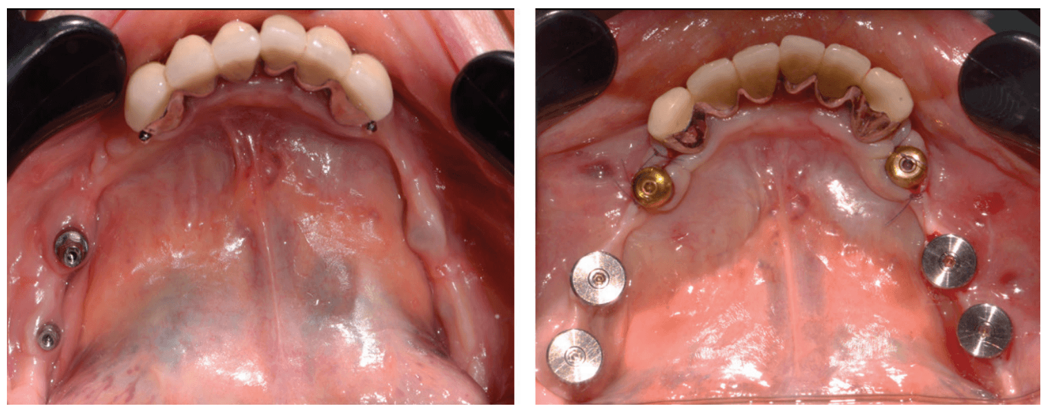 Subperiosteal implants — customization with CAD/CAM