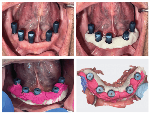 Intraoral scanning — key to full-arch implant positioning