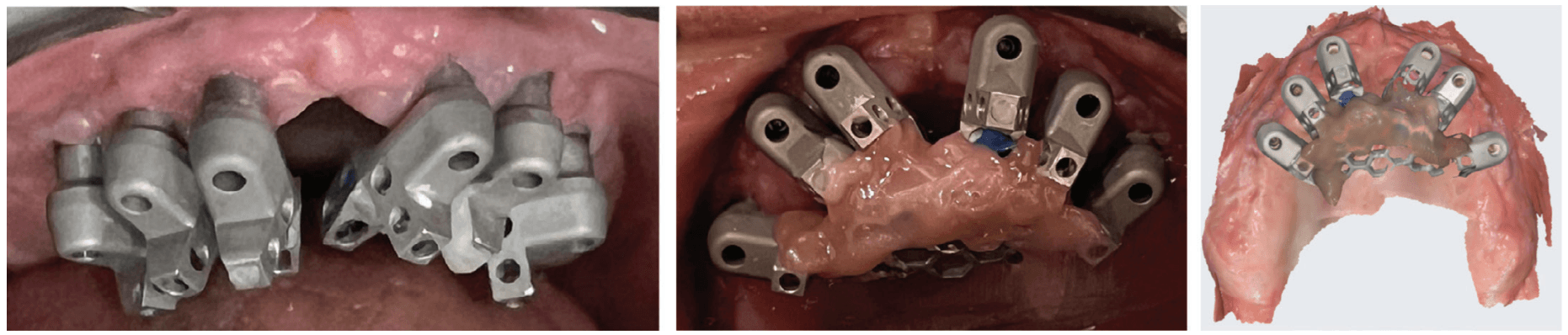 Intraoral scanning — key to full-arch implant positioning