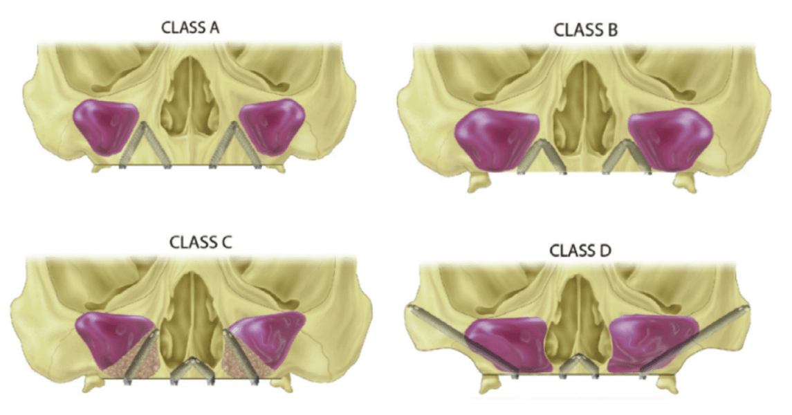 Full-arch implants — guidelines for better outcomes
