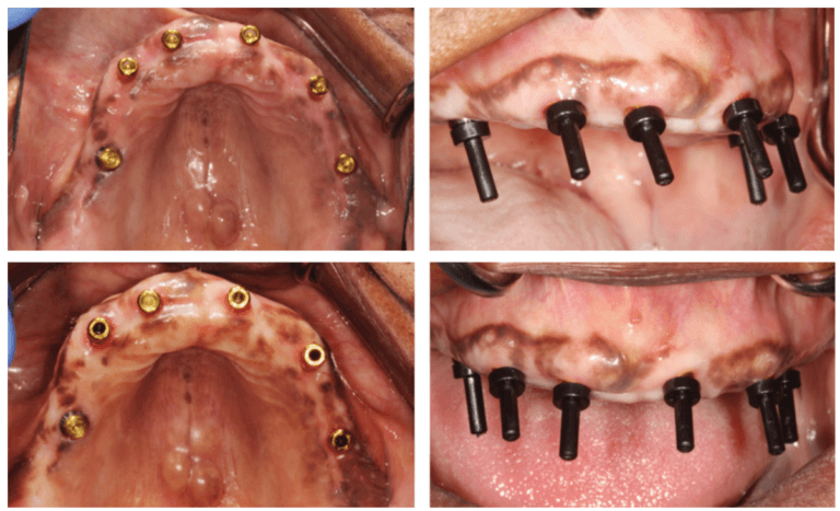 Locator Angled abutments — a solution for non-ideal implant angulations