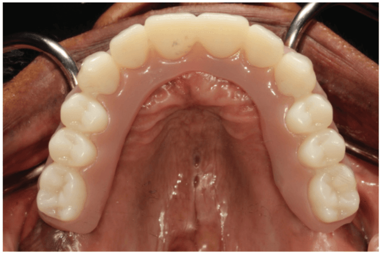 Locator Angled abutments — a solution for non-ideal implant angulations